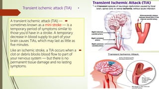 Stroke | PPTX