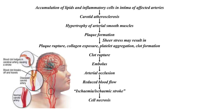 Classification, Pathophysiology and management of Brain Stroke for Pharm.D (Pharmacotherapeutics ...