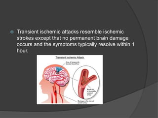 Stroke | PPTX