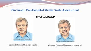 Stroke | PPTX