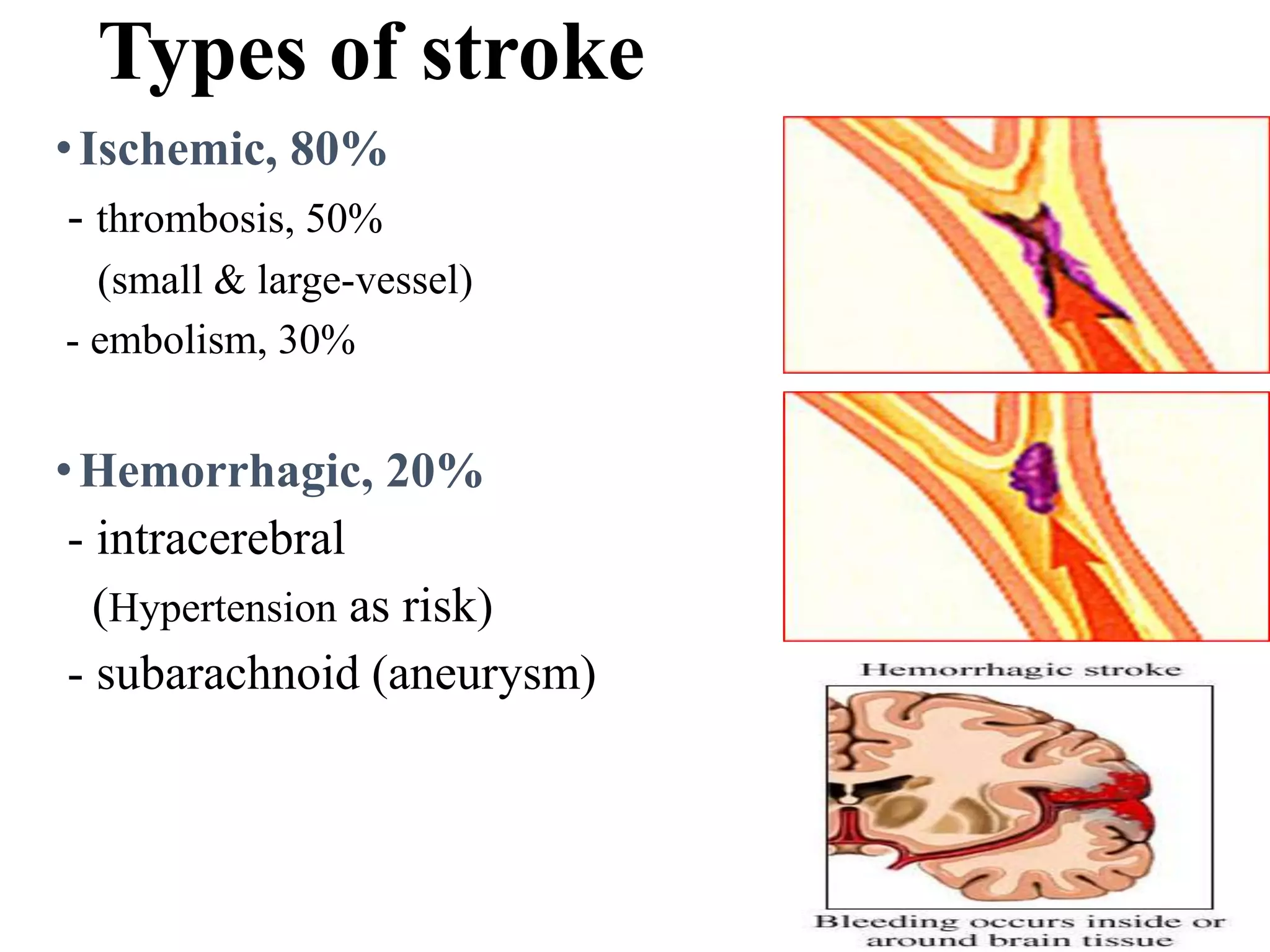 Stroke.ppt