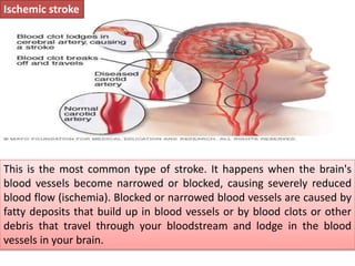 STROKE.pptx