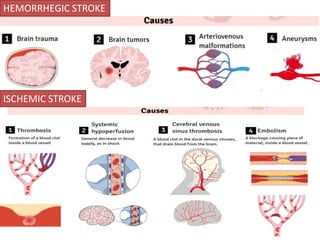 STROKE.pptx