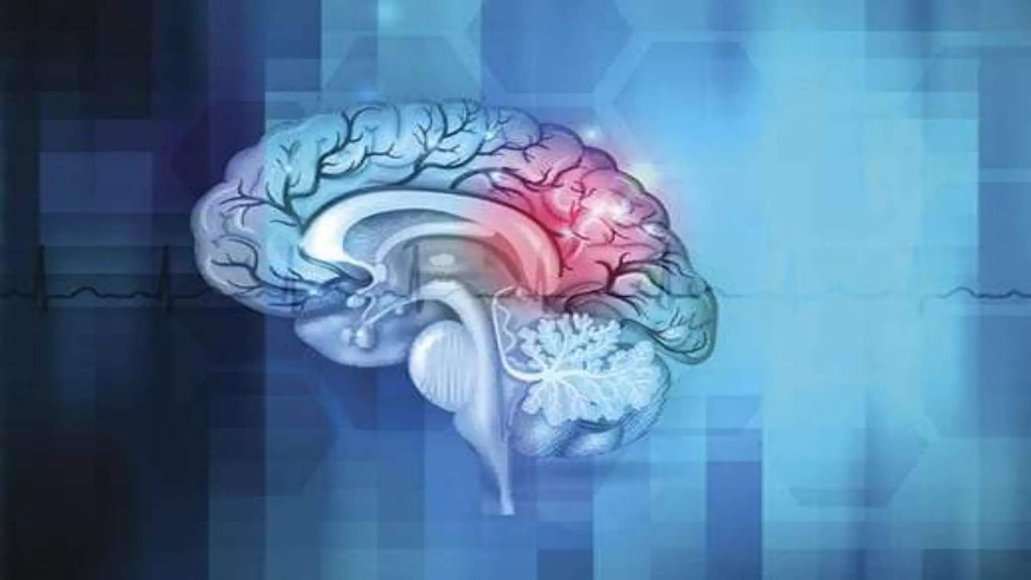 stroke presentation that covers every aspect of Focal neurological ...