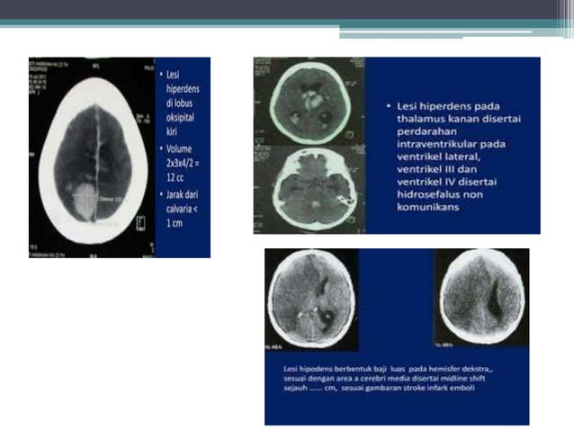 Power Point Penyakit Stroke Yang Sering di derita di Masyarakat | PPT