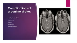 Stroke and stroke syndrome for physiotherapy.pptx