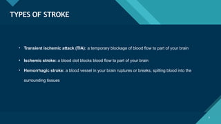 "Understanding Stroke: Causes, Symptoms, and Prevention" | PPTX