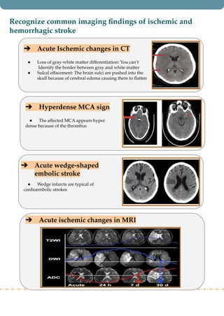 Pathophysiology of Stroke for pathology.pdf