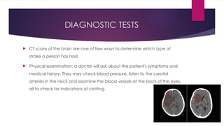 Stroke powerpoint presentation definition types | PPT