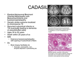 Stroke.ppt current practice and management | PPT