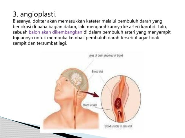 STROKE power point for penyuluhan prolanis | PPTX