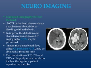 Brain stroke: Symptoms, Classification, prevention and management .pptx