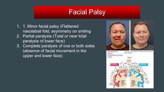 Stroke a clinical talk | PPT