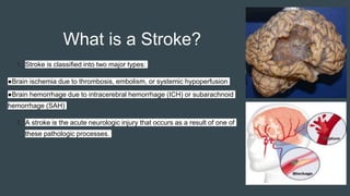 Stroke a clinical talk | PPT