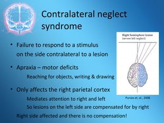 Stroke & Balint's syndrome | PPT