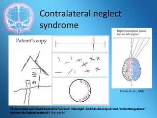 Stroke & Balint's syndrome | PPT