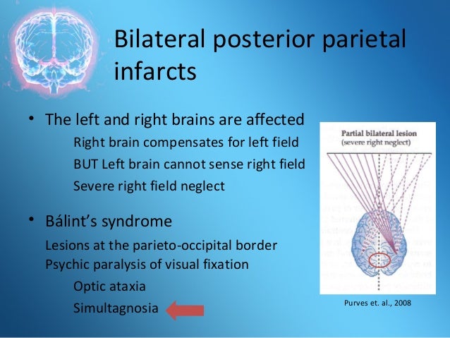 Stroke & Balint's syndrome