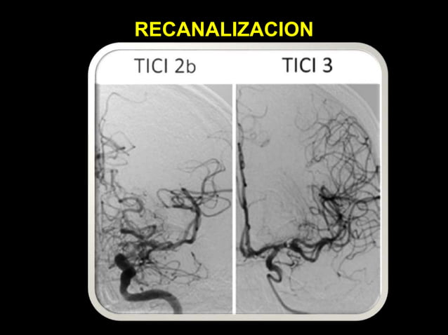 Manejo Del Ictus Isquémico Agudo Terapia Endovascular