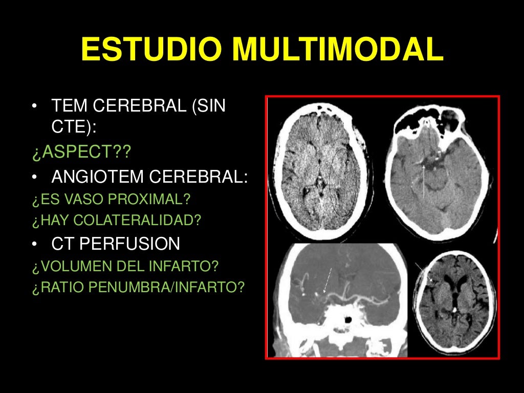 Manejo Del Ictus Isquémico Agudo Terapia Endovascular