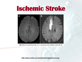 Stroke Presentation Ms | PPT | Brain and Nervous System Disorders | Diseases and Conditions
