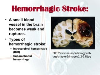 Stroke Presentation Ms | PPT | Brain and Nervous System Disorders | Diseases and Conditions