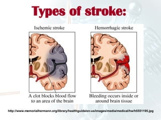 Stroke Presentation Ms | PPT | Brain and Nervous System Disorders | Diseases and Conditions