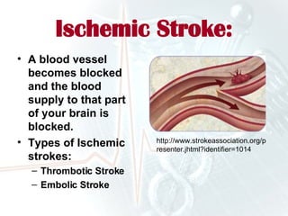 Stroke Presentation Ms | PPT | Brain and Nervous System Disorders | Diseases and Conditions