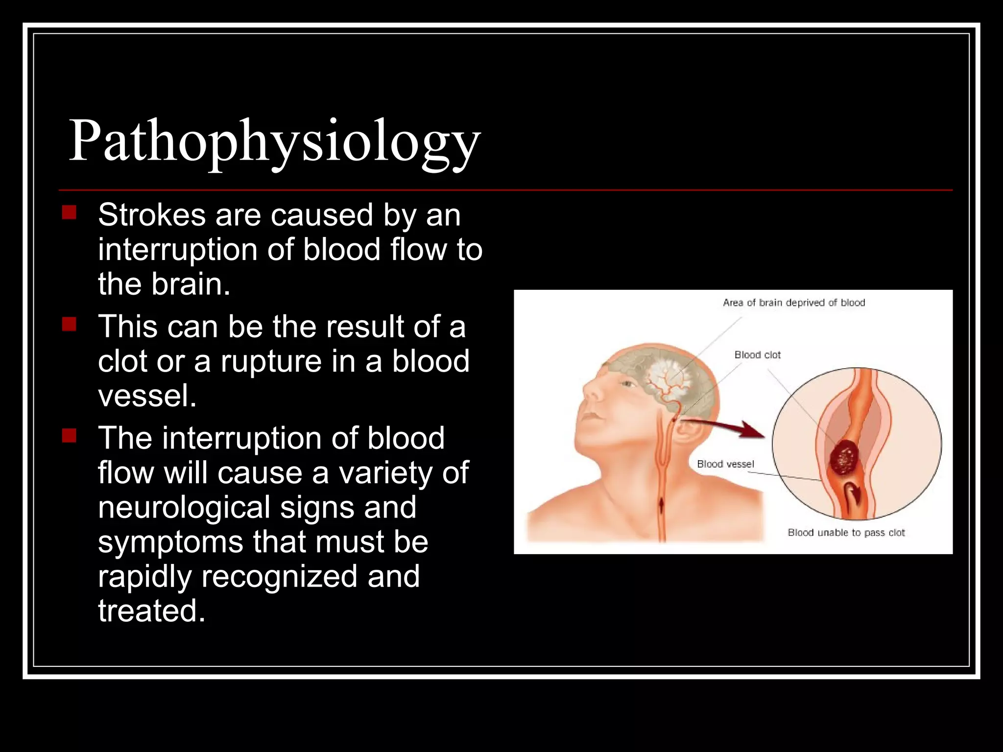 Stroke Recognition And Treatment | PPT