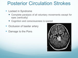 stroke-syndromes.pdf
