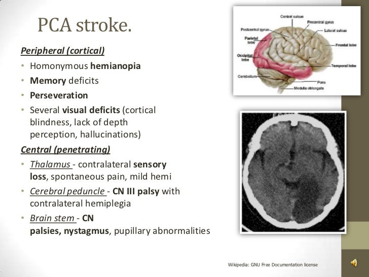 Stroke and cerebrovascular accident