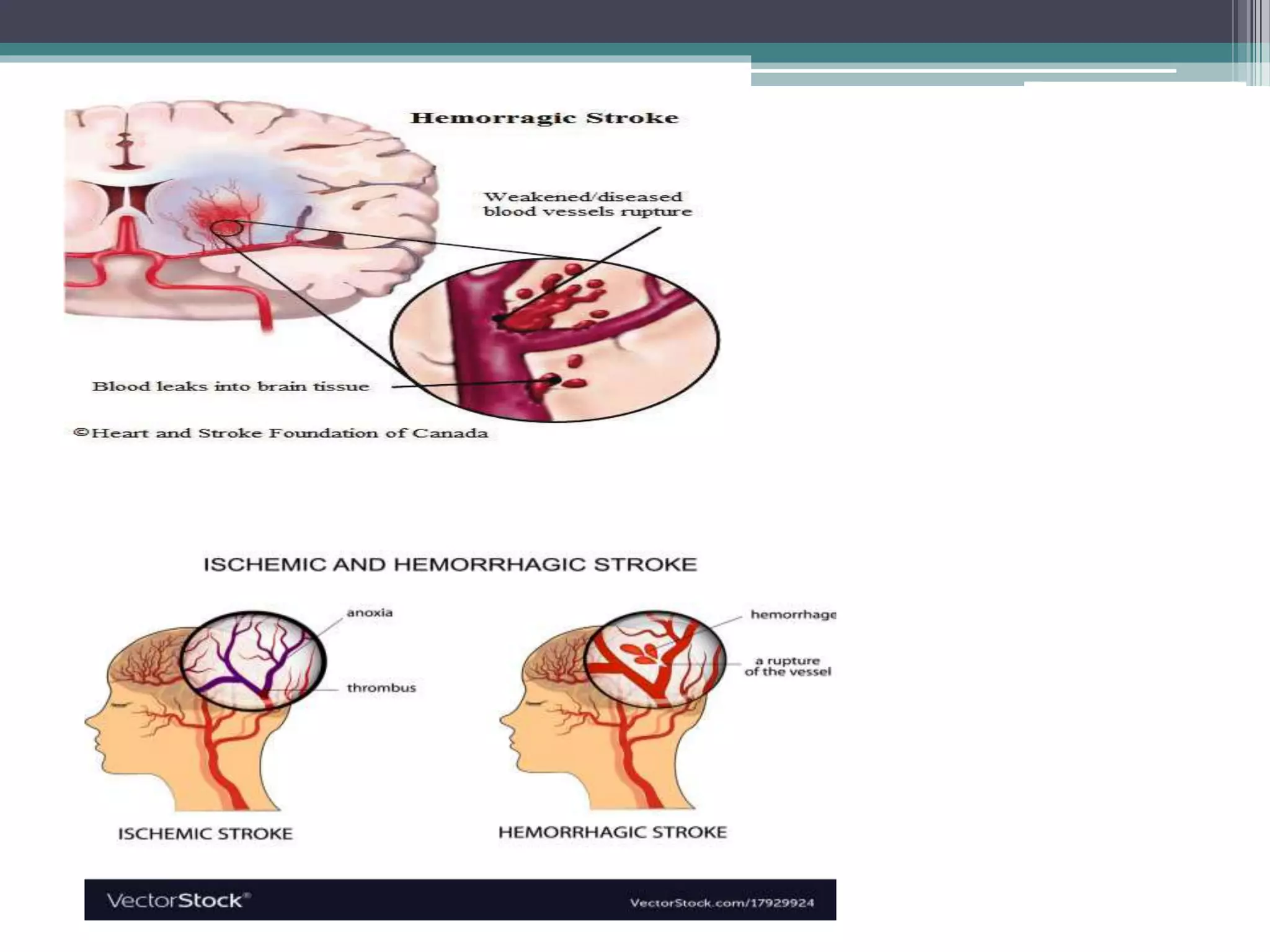Stroke and its Types.pptx