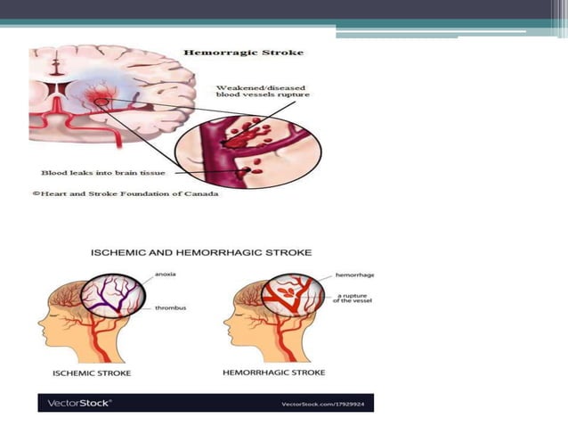 Stroke and its Types.pptx
