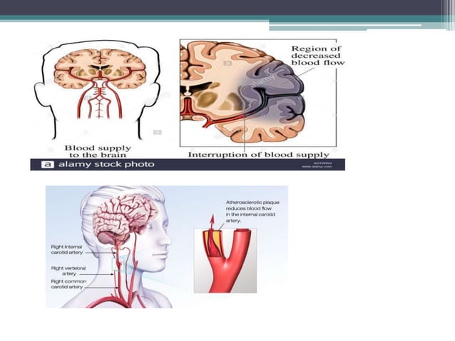 Stroke and its Types.pptx