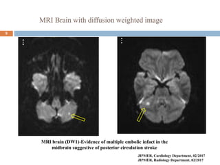 Stroke a rare complication in Post PCI patient | PPT