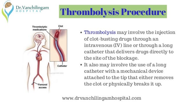 Stroke and the importance of thrombolysis