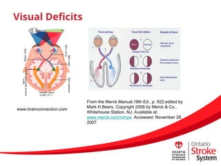 Stroke_Assessment NIH Stroke Scale 1.ppt
