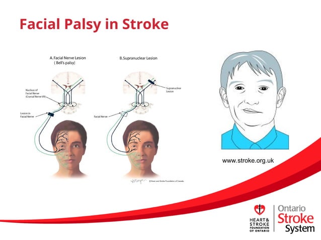 Stroke_Assessment NIH Stroke Scale 1.ppt | Brain and Nervous System ...