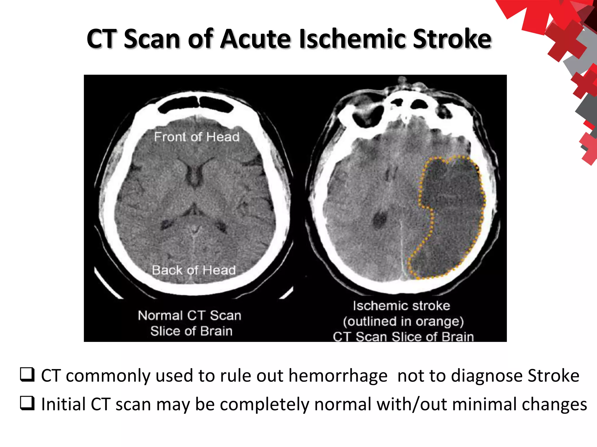Stroke Awareness.pptx