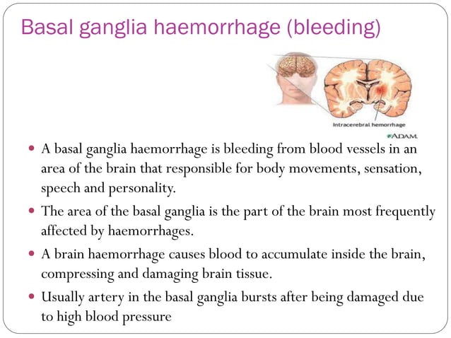 Stroke basal ganglia bleed | PDF | Brain and Nervous System Disorders ...