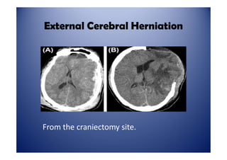 Stroke Care of Patient With Post Decompressive Craniectomy | PDF