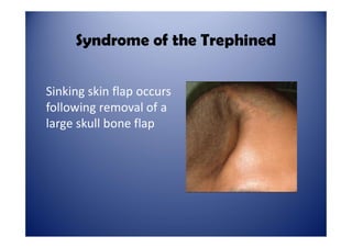 Stroke Care of Patient With Post Decompressive Craniectomy | PDF