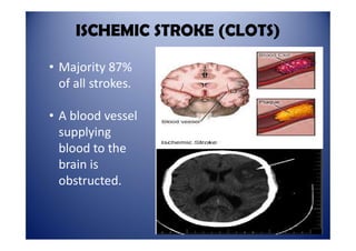 Stroke Care of Patient With Post Decompressive Craniectomy | PDF