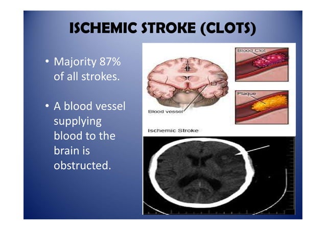 Stroke Care of Patient With Post Decompressive Craniectomy | PPT
