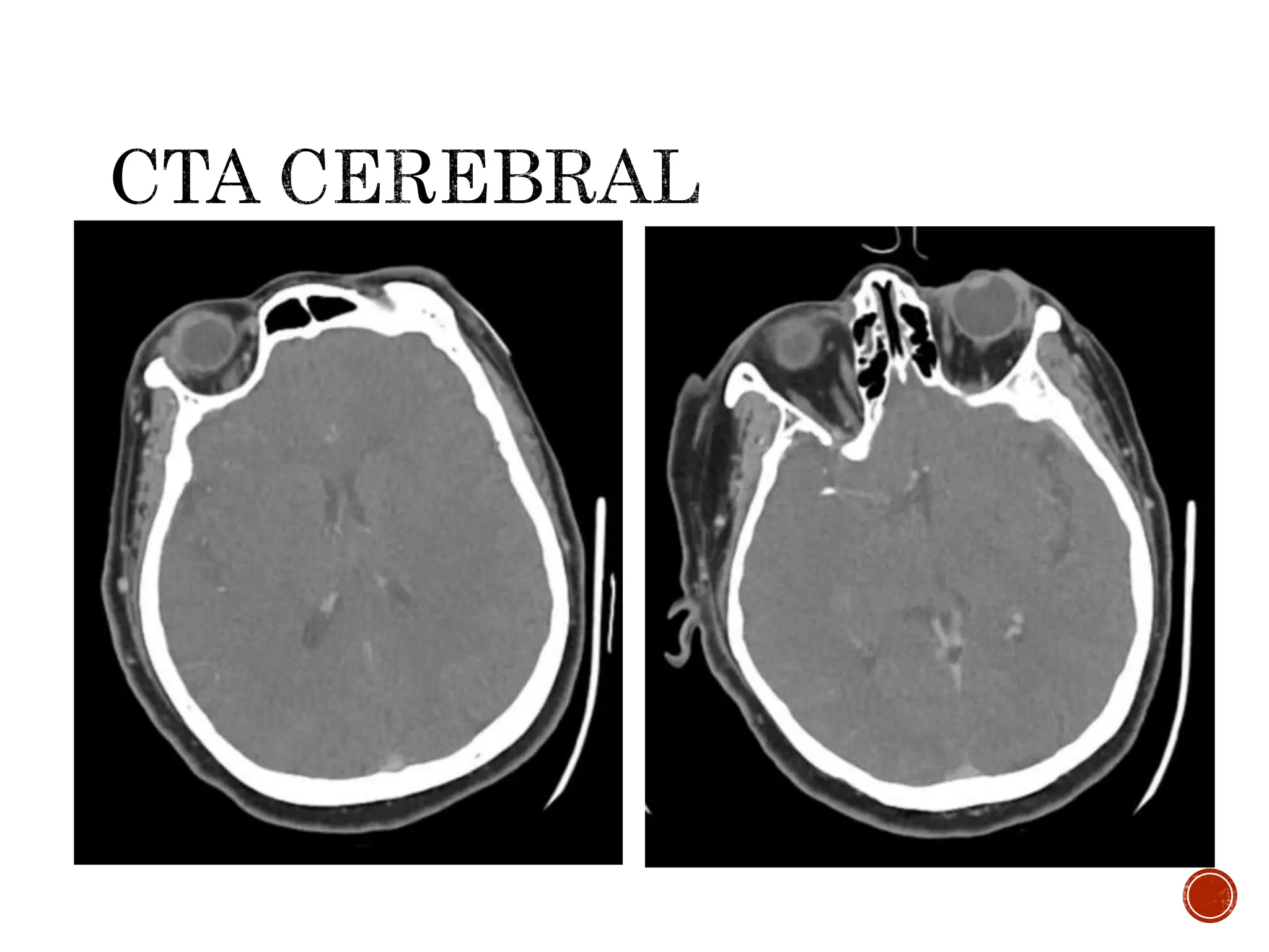 Stroke Code Case Report And Protocolpptx 7977