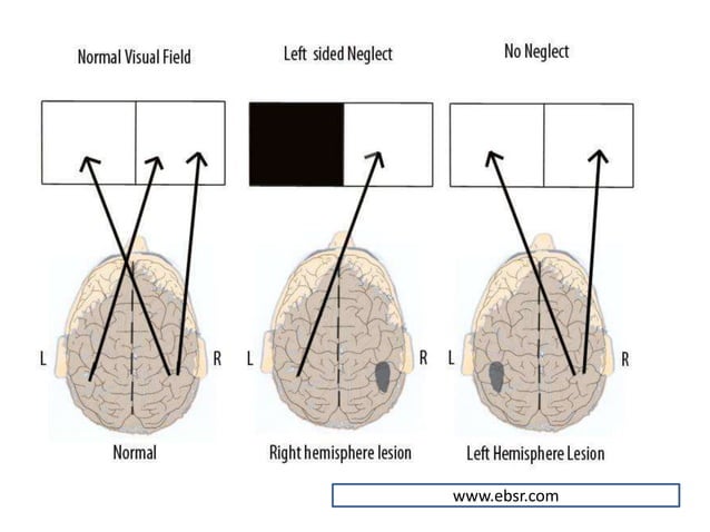 Stroke cognitive deficits and rehabilitation dr venugopal kochiyil ...