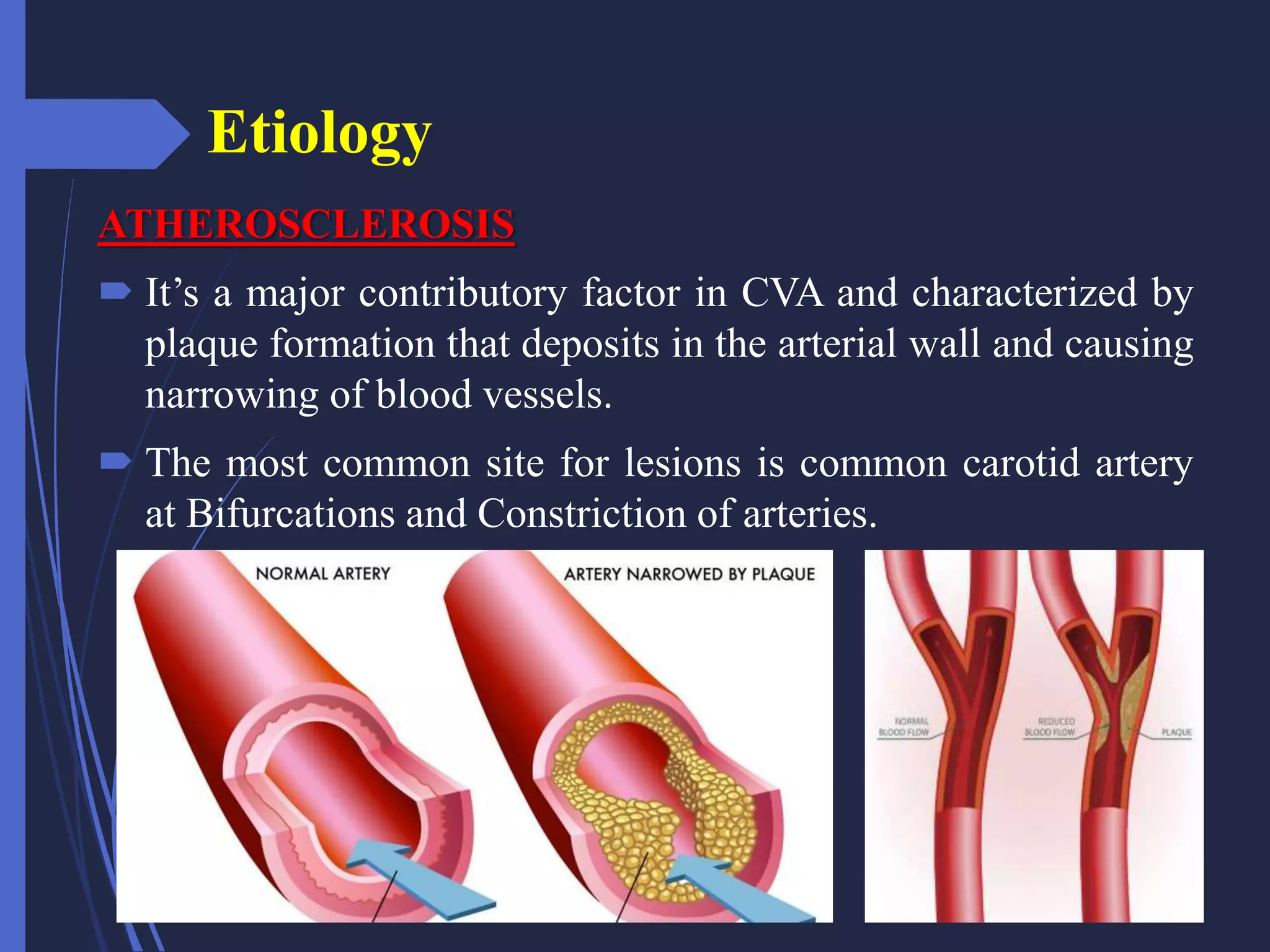 Stroke (cva) , CVA, Cerebrovascular Accident, Transient Ischemic Attack ...