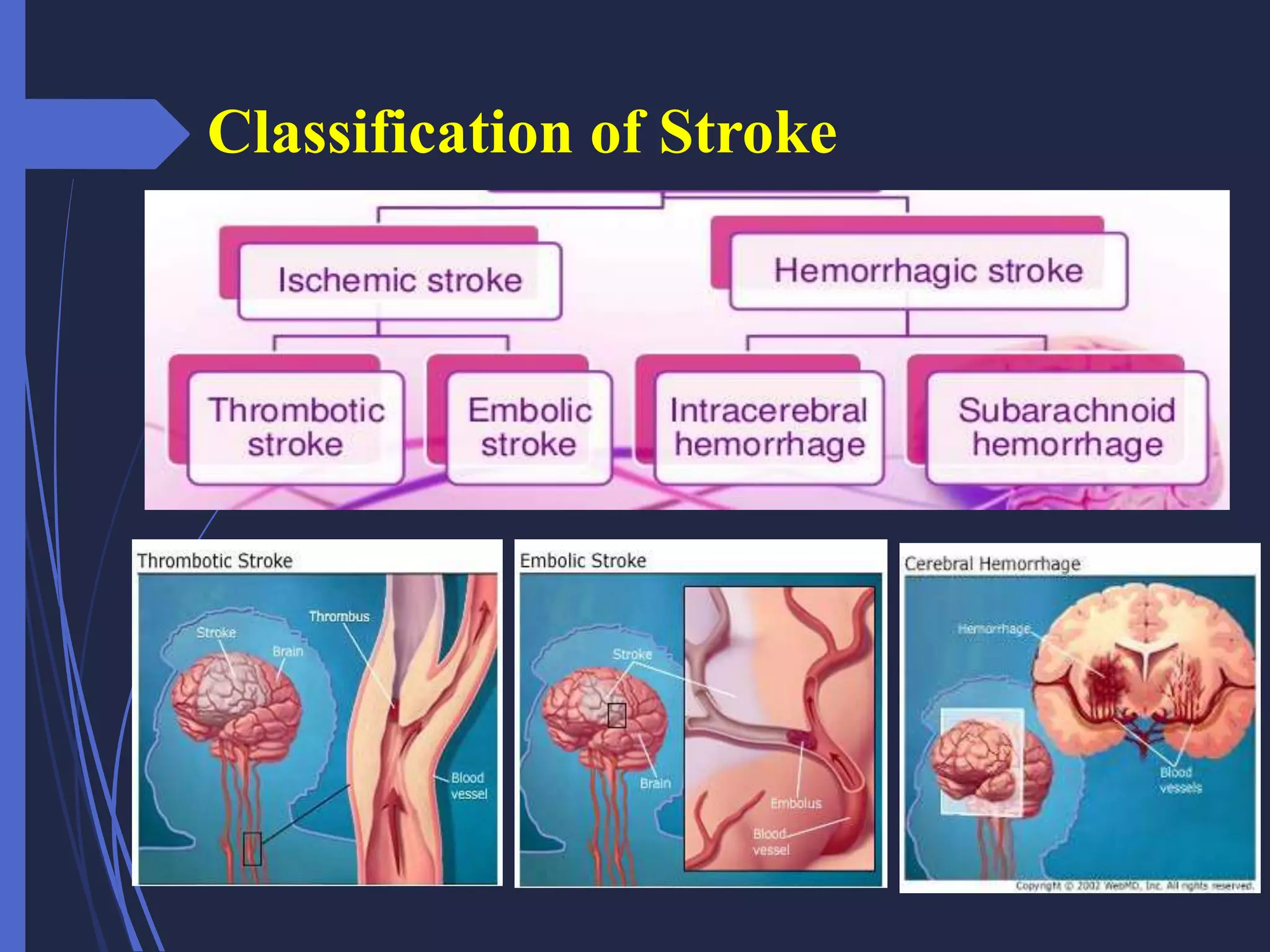 Stroke (cva) , CVA, Cerebrovascular Accident, Transient Ischemic Attack | PPT