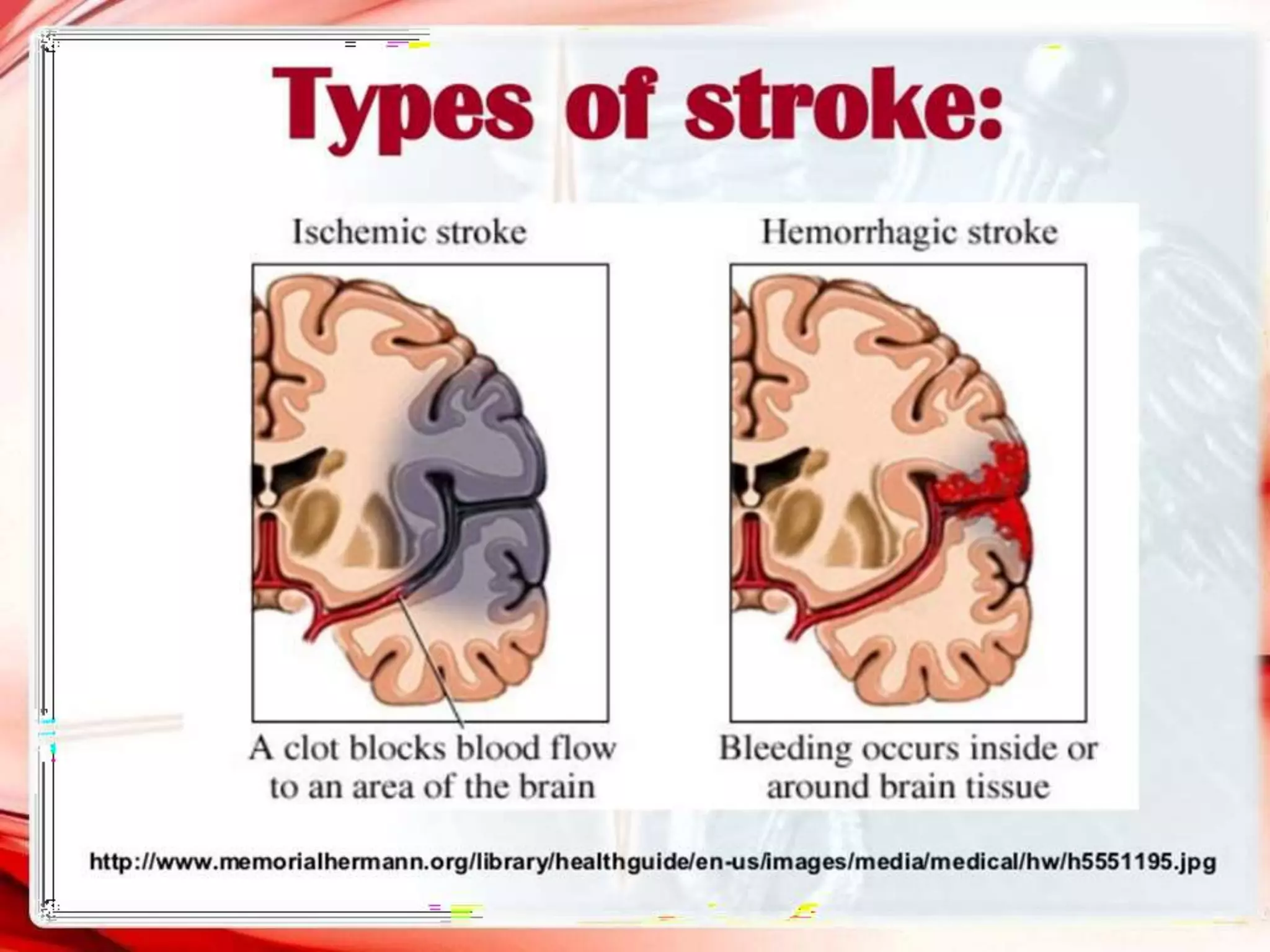 Stroke CVa.pptx