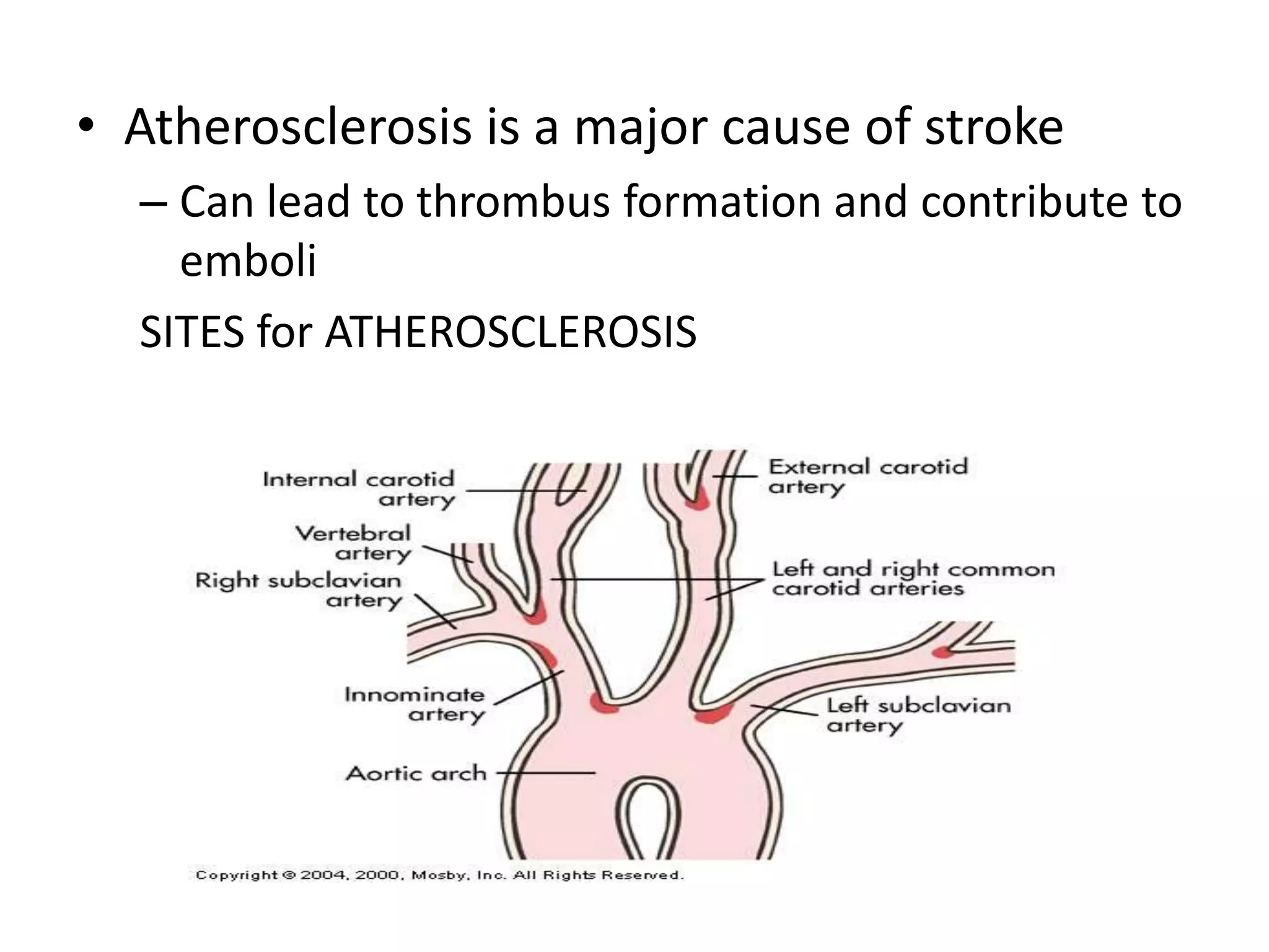 CVA- Ischemic Stroke Case Study | PPTX