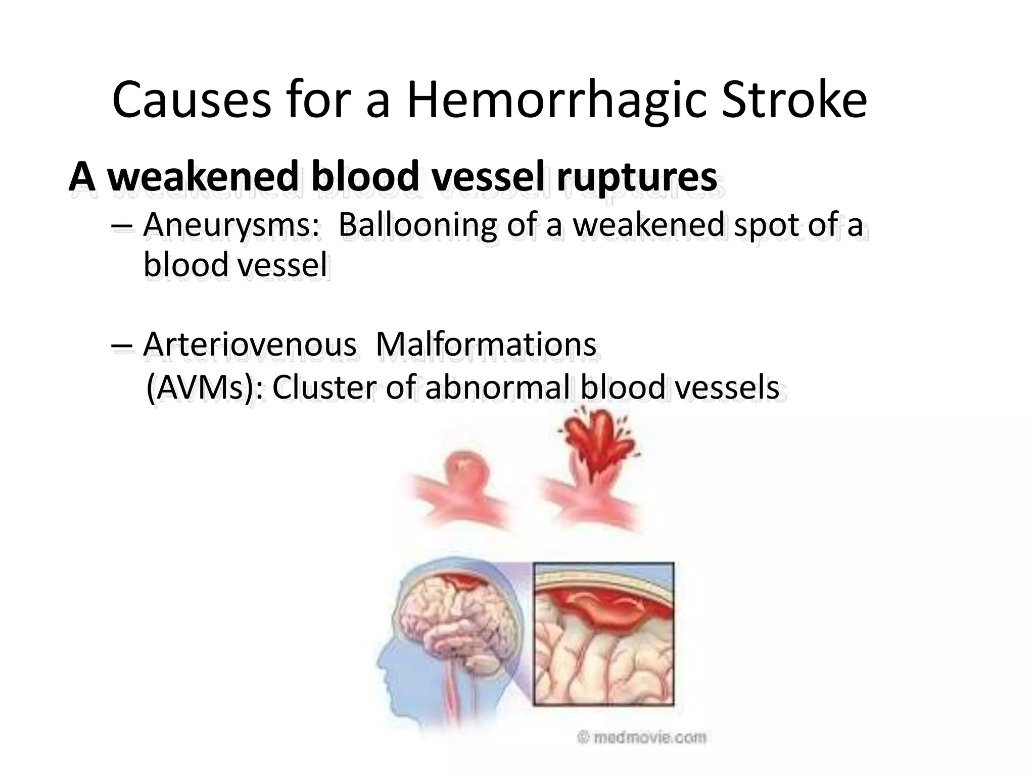 CVA- Ischemic Stroke Case Study | PPTX